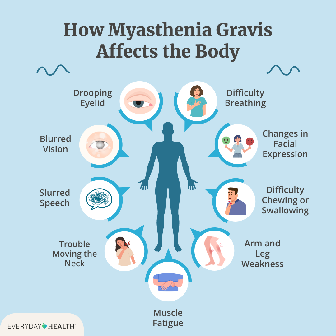 Myasthenia Gravis – from Symptoms to Diagnosis to Treatment